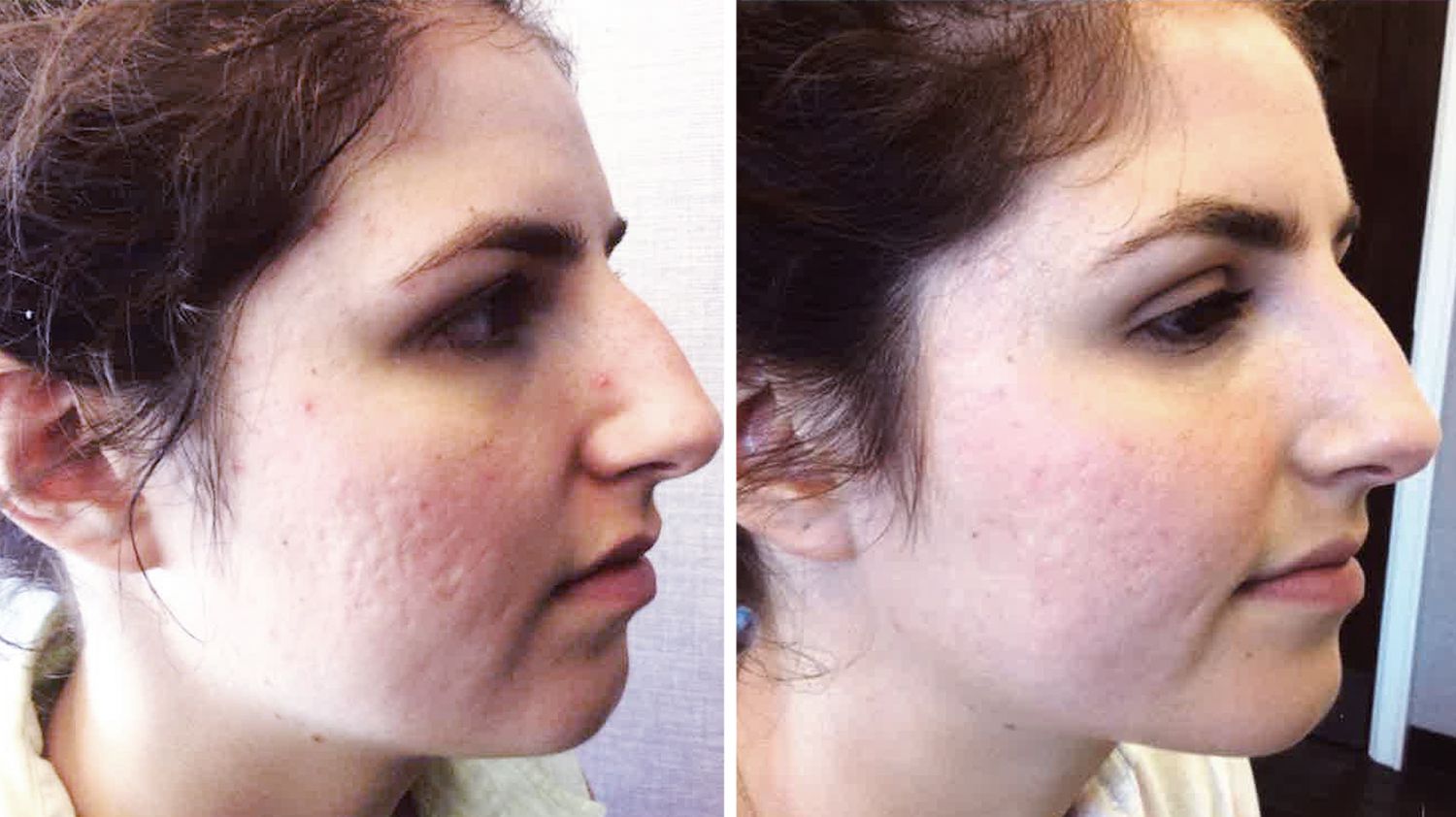 Laser For Acne Lesions Shubham Skin Clinic Award Winning Skin Laser For Acne Lesions Shubham Skin Clinic Award Winning Skin
